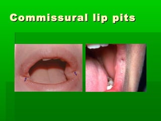 Anomalies of oral & para oral region