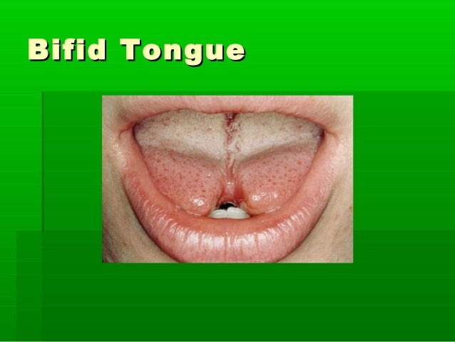 Anomalies of oral & para oral region