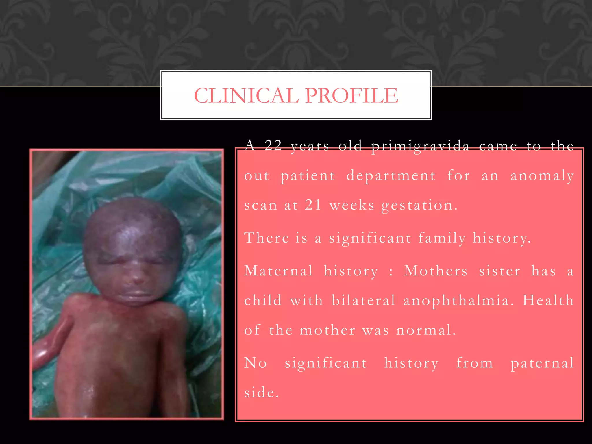 Anophthalmia poster final | PPTX