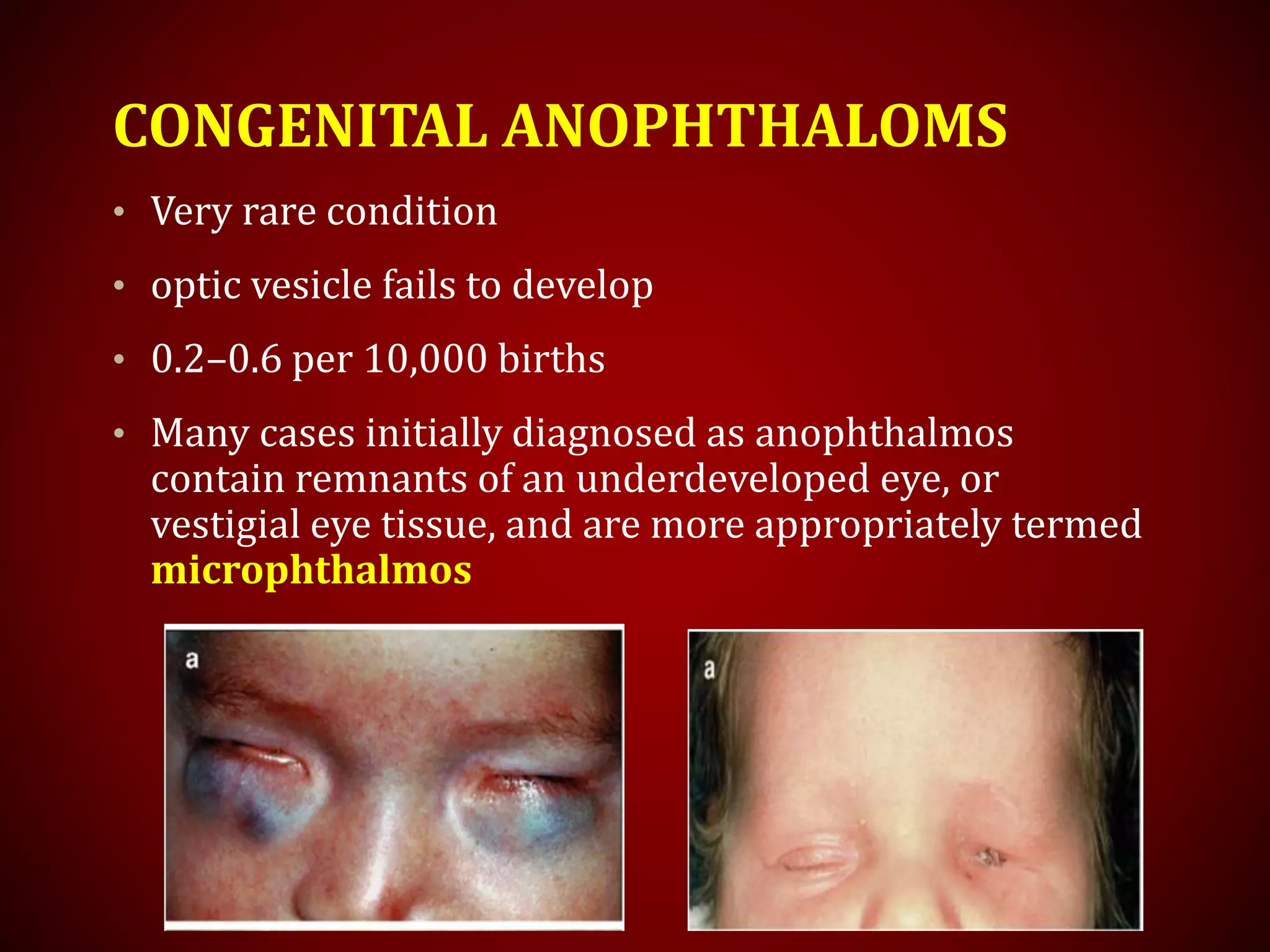Anophthalmic socket | PPT