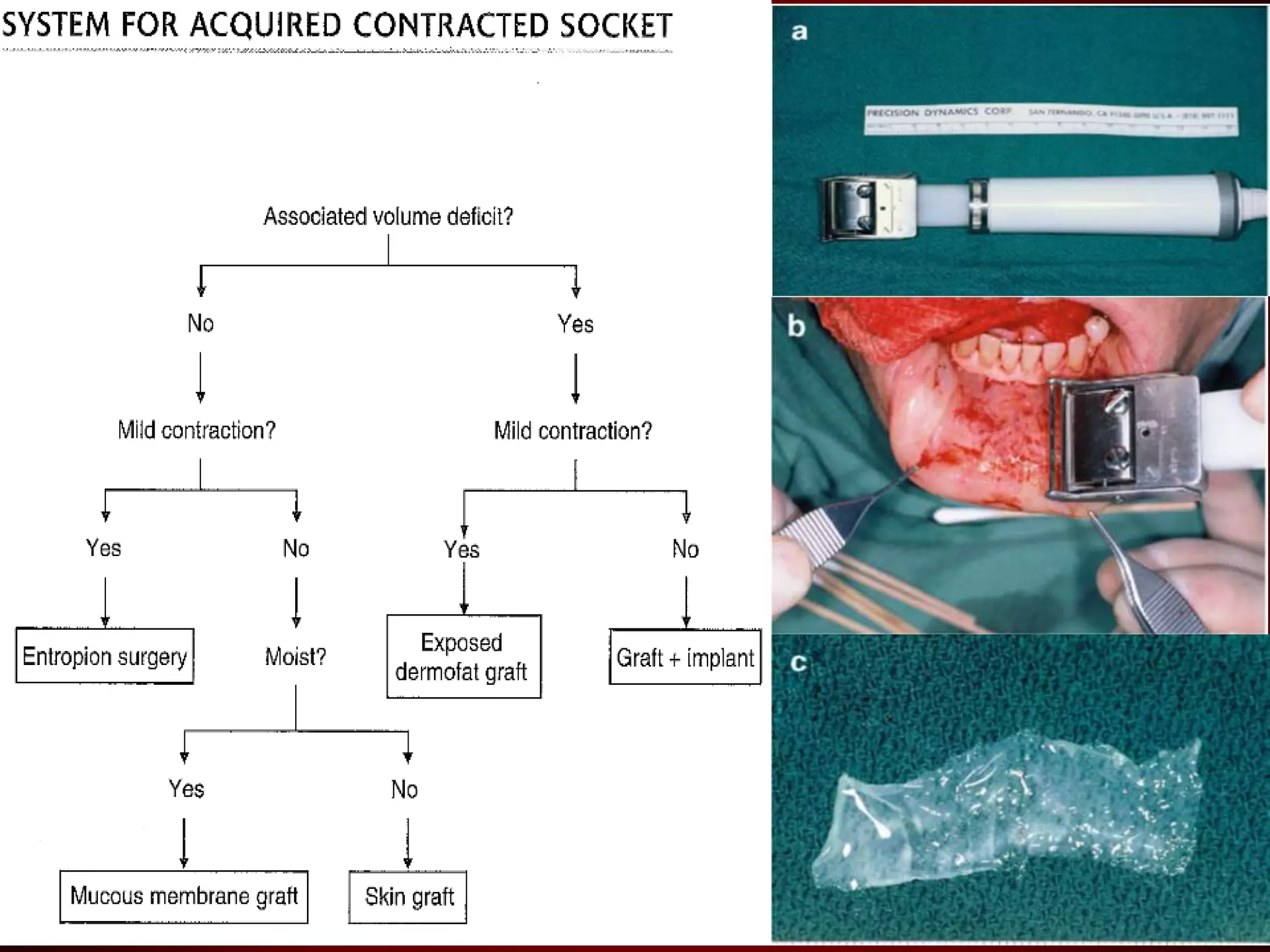 Anophthalmic socket | PPTX