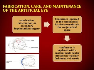 Anophthalmic socket | PPT