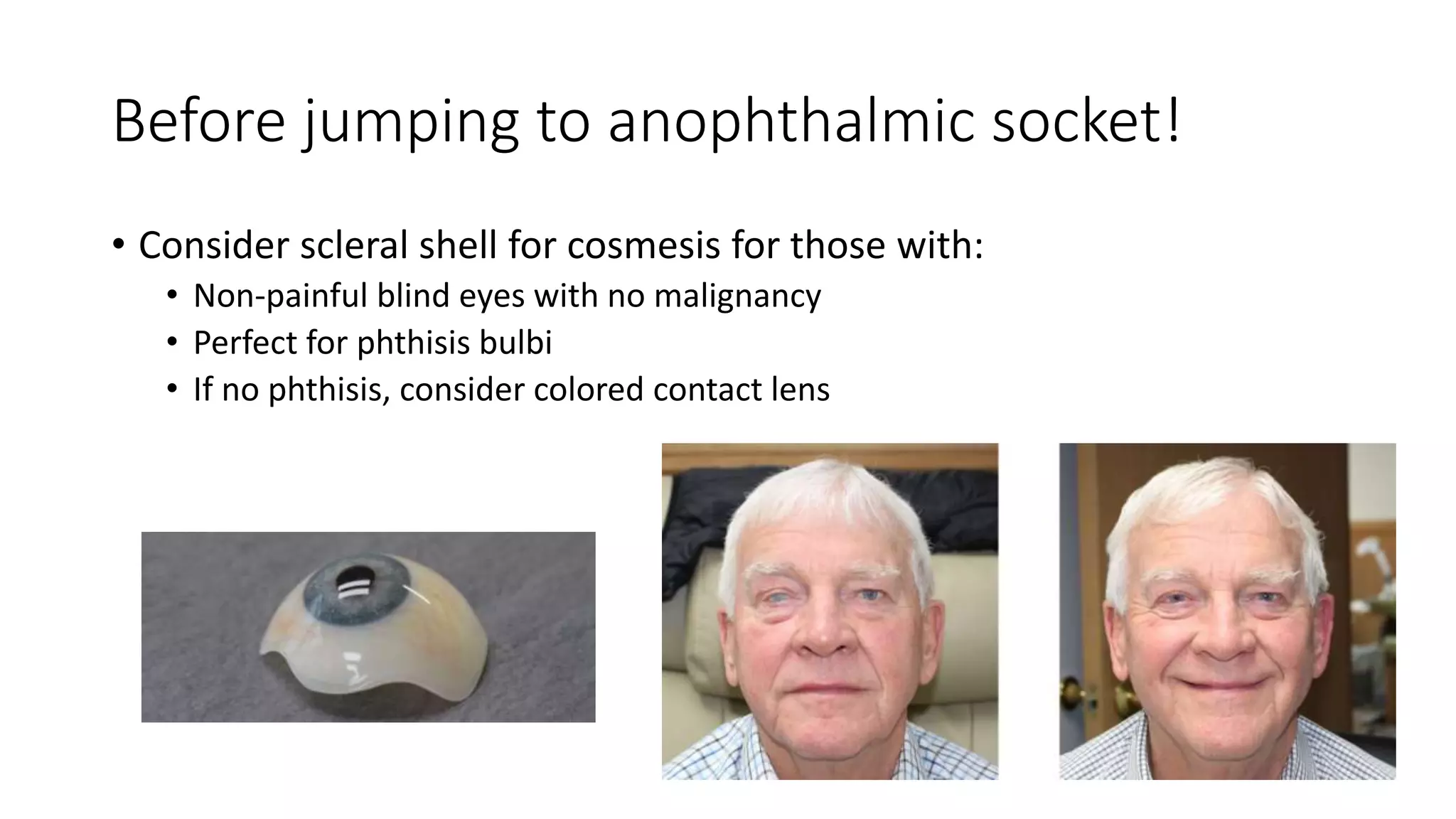 Anophthalmic socket (evisceration, enucleation, exenteration) | PPTX