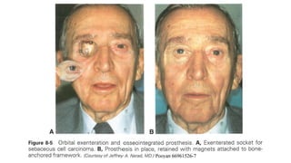 Anophthalmic socket (evisceration, enucleation, exenteration) | PPTX