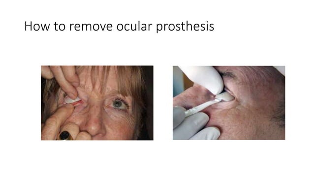 Anophthalmic socket (evisceration, enucleation, exenteration) | PPTX ...