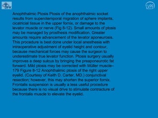 Anophthalmic socket.pptx