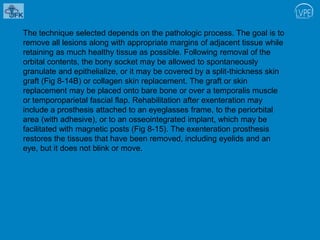 Anophthalmic socket.pptx
