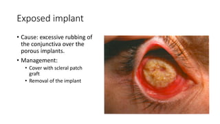 Anophthalmic socket.pdf
