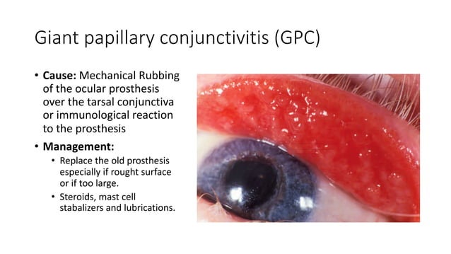 Anophthalmic socket.pdf | Eye and Vision Conditions | Diseases and ...