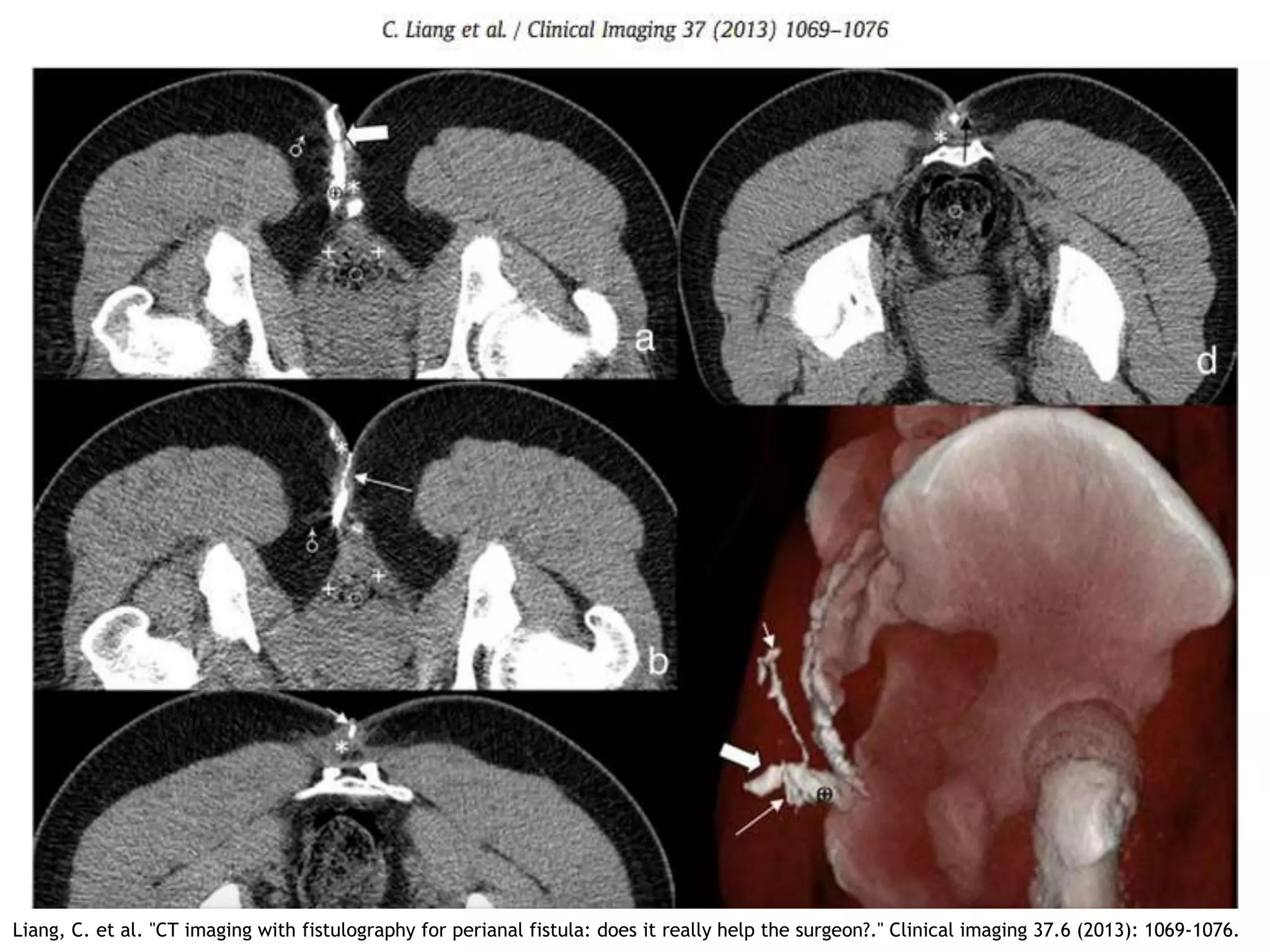 Absceso y fístula anorrectal | PPTX