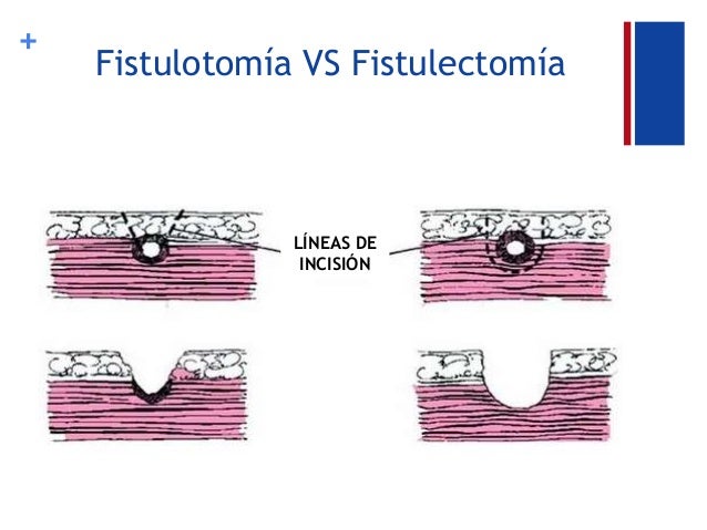 Absceso y fístula anorrectal