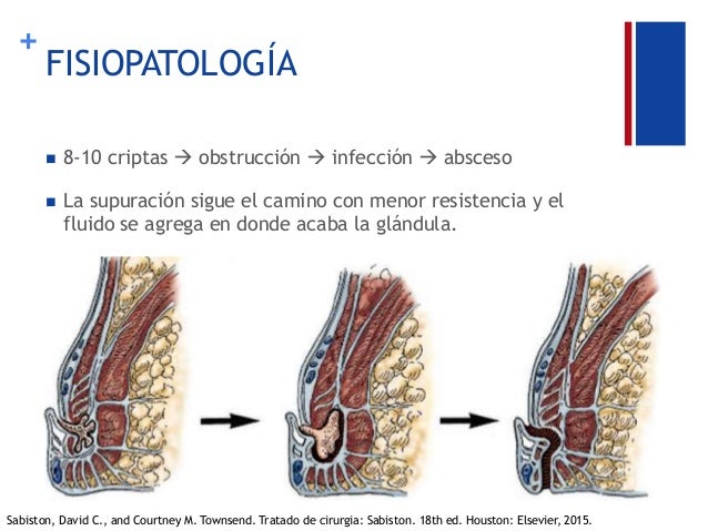 Absceso y fístula anorrectal