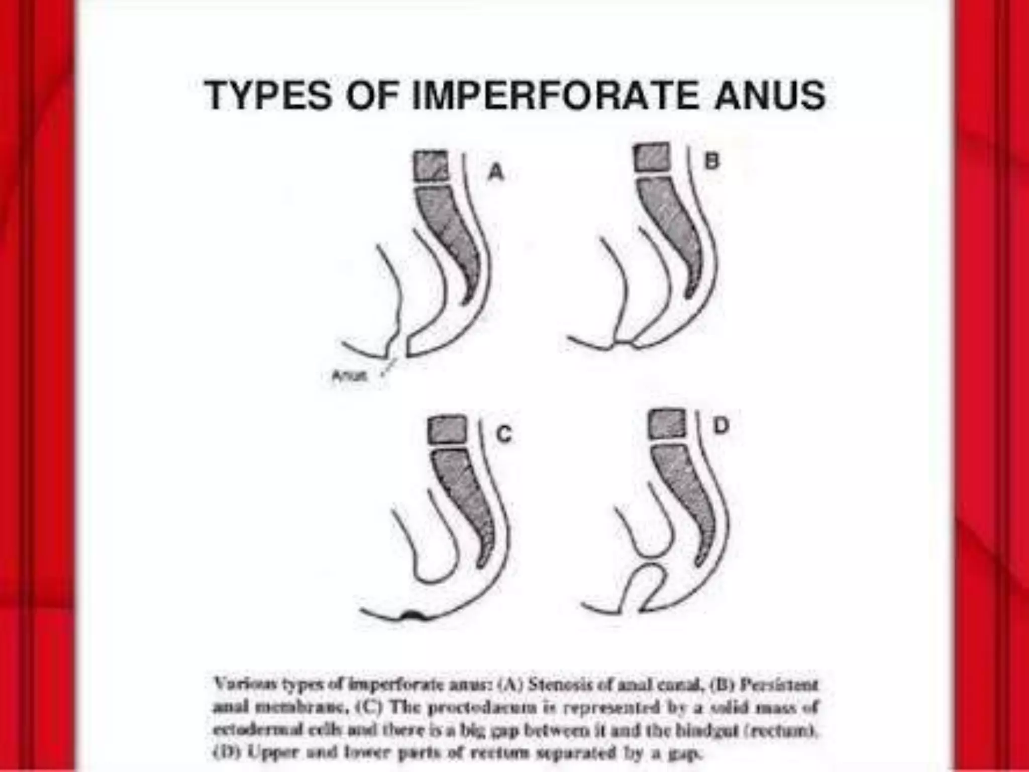 Anorectal Malformation | PPTX