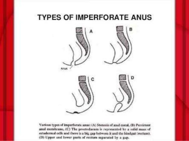 Anorectal Malformation | PPT