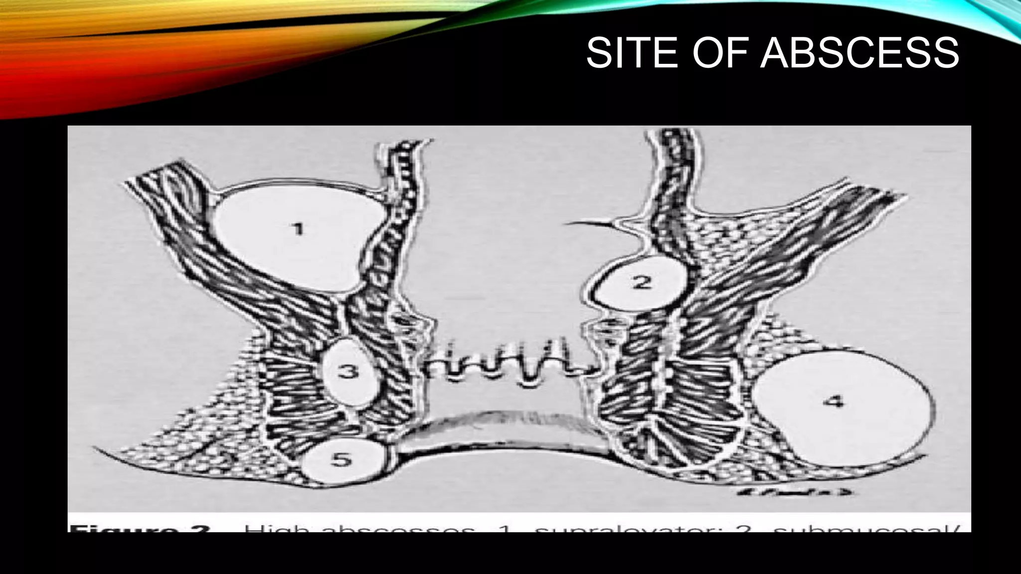 Anorectal Abscess, Anal/ Perianal/ Rectal Abscess | PPTX