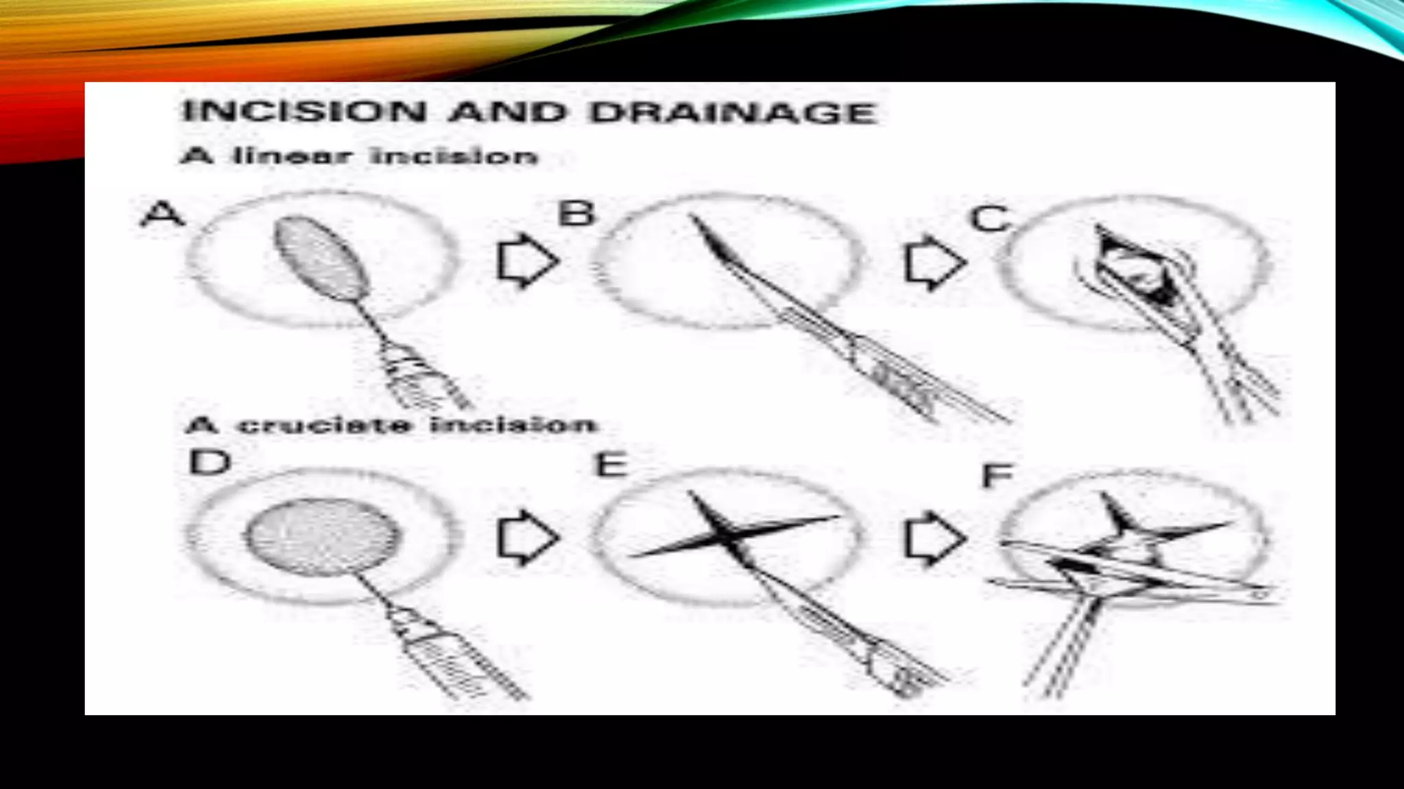 Anorectal Abscess, Anal/ Perianal/ Rectal Abscess | PPTX