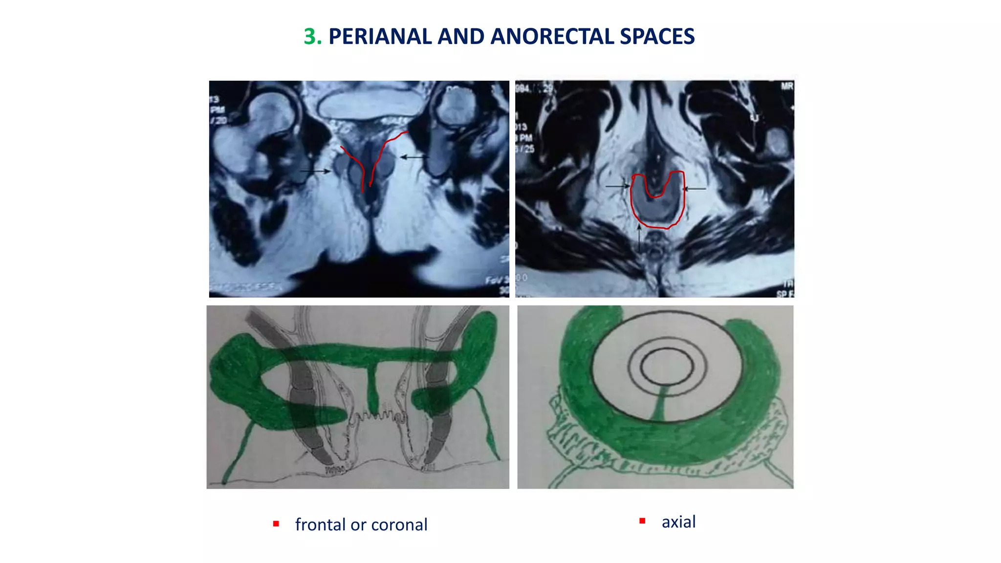 Anorectal abscess and fistula in ano | PPT | First Aid | Injuries