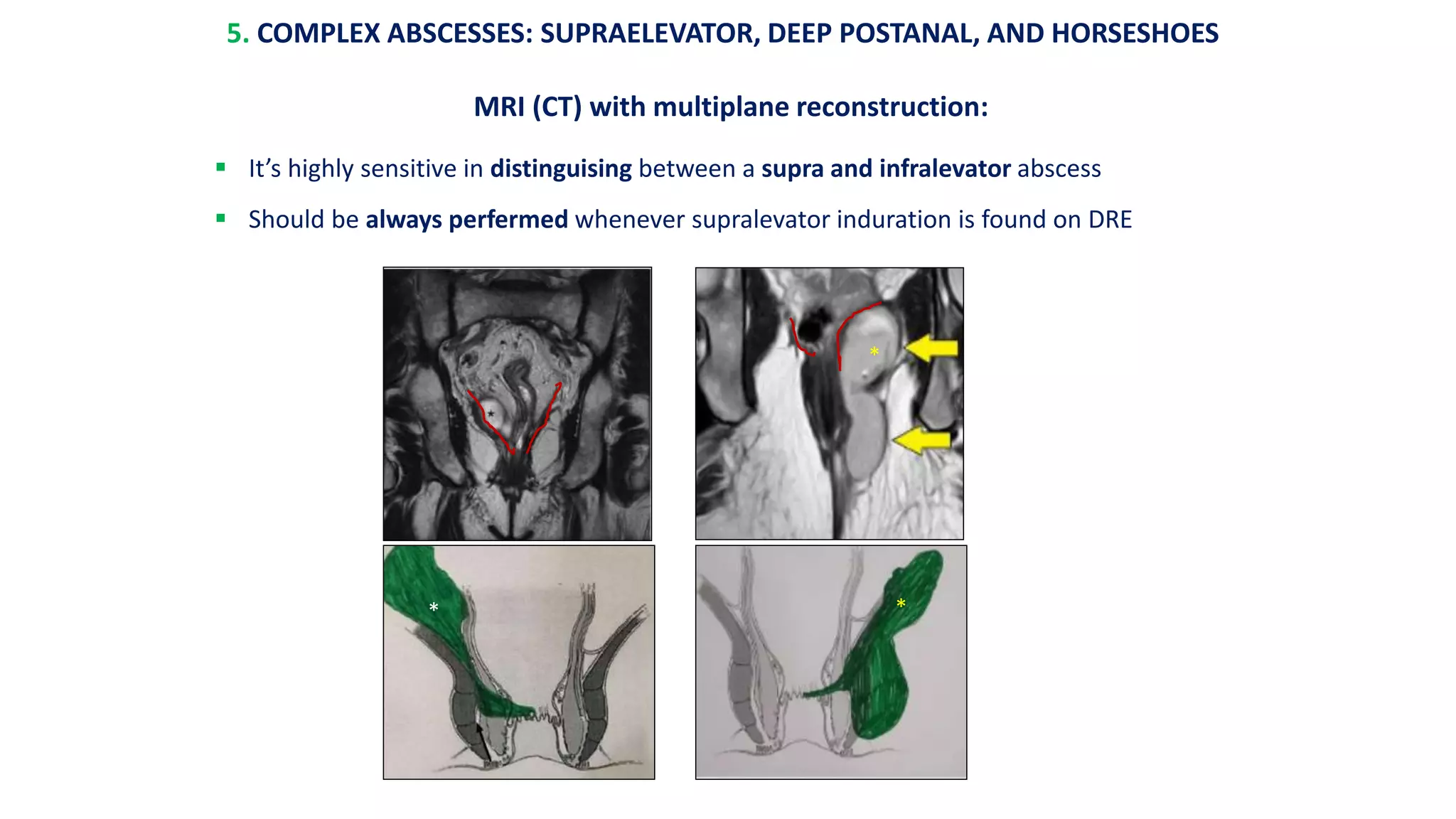Anorectal abscess and fistula in ano | PPT