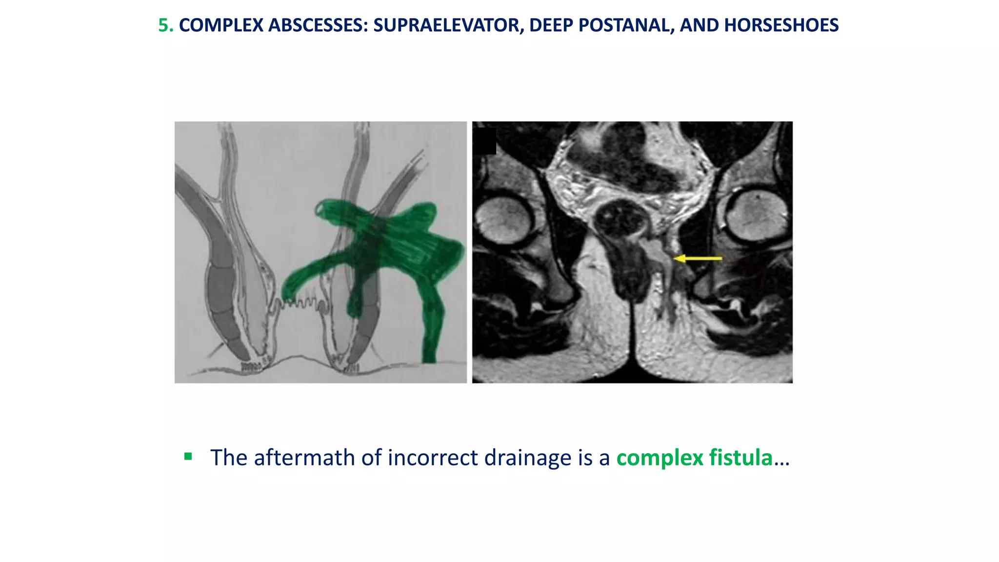 Anorectal abscess and fistula in ano | PPT | First Aid | Injuries