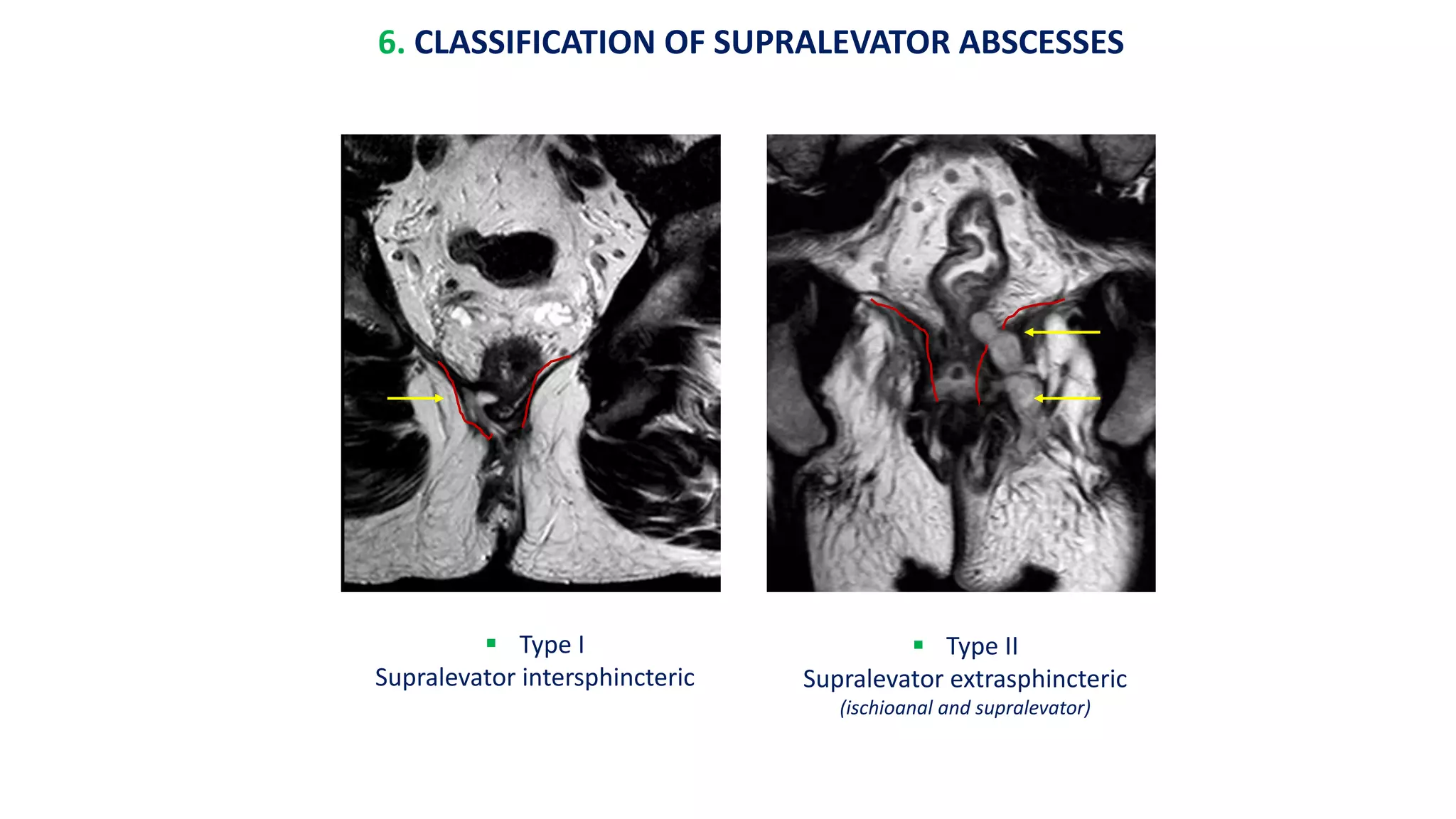 Anorectal abscess and fistula in ano | PPT