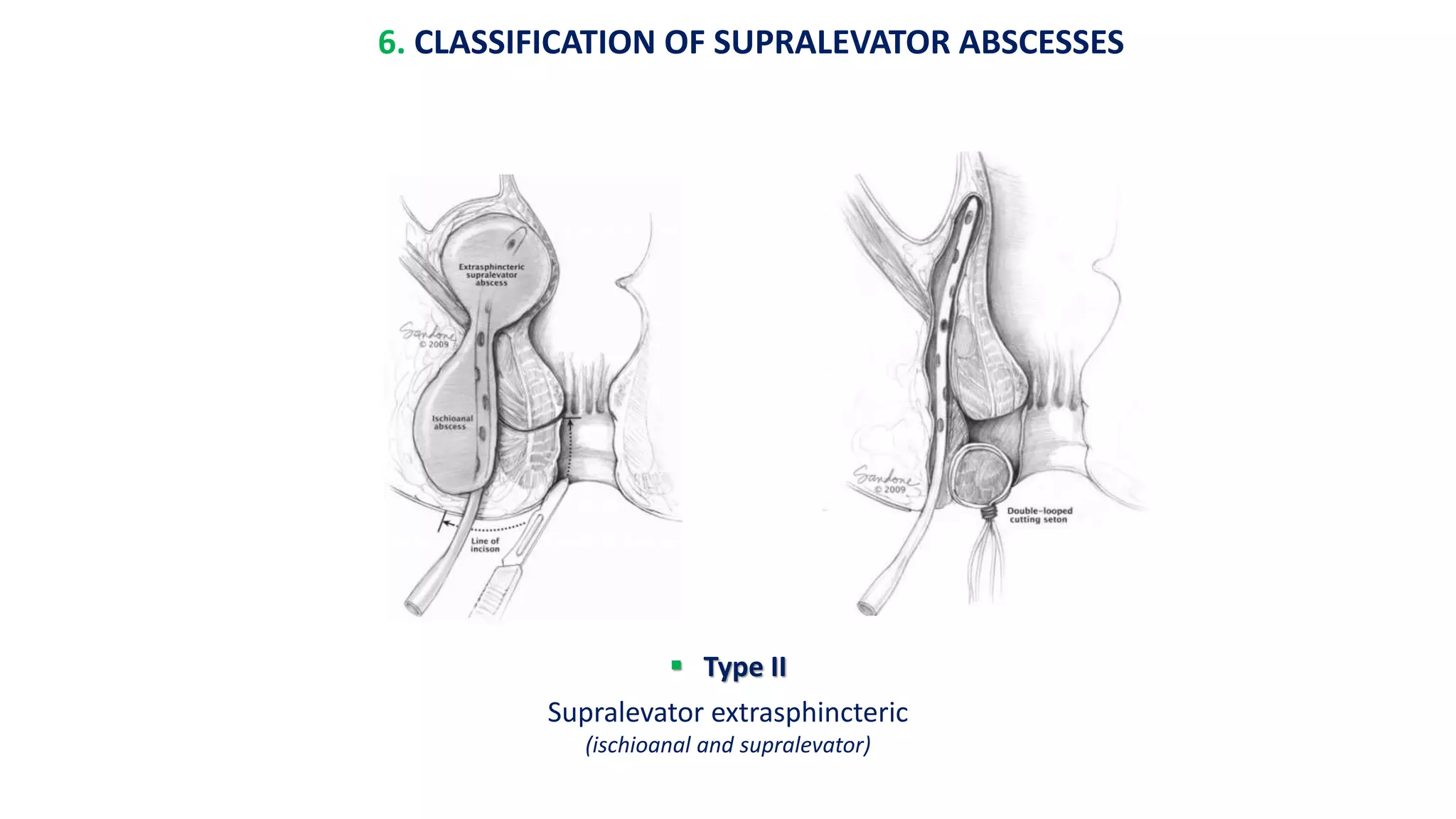 Anorectal abscess and fistula in ano | PPT