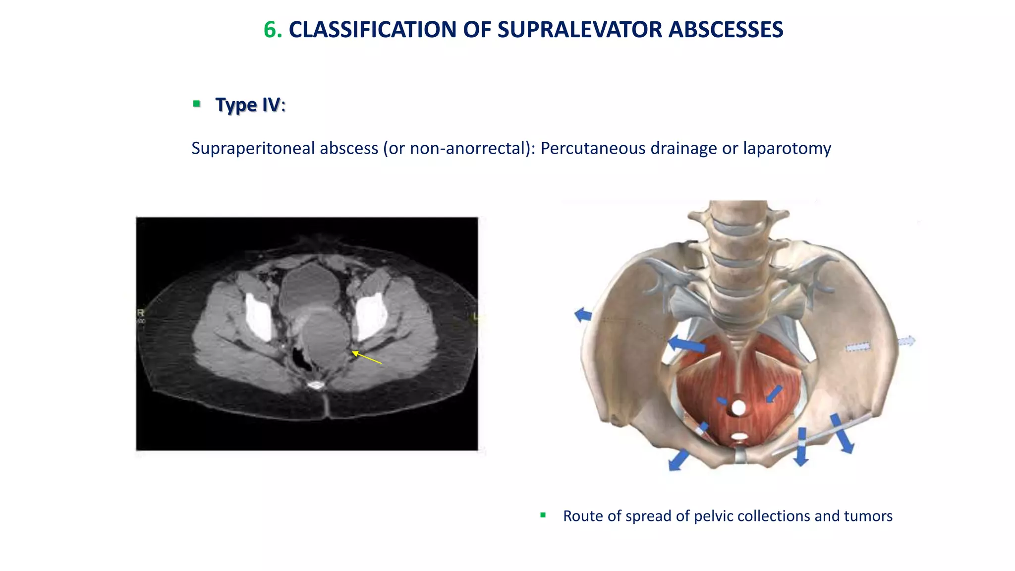 Anorectal abscess and fistula in ano | PPT