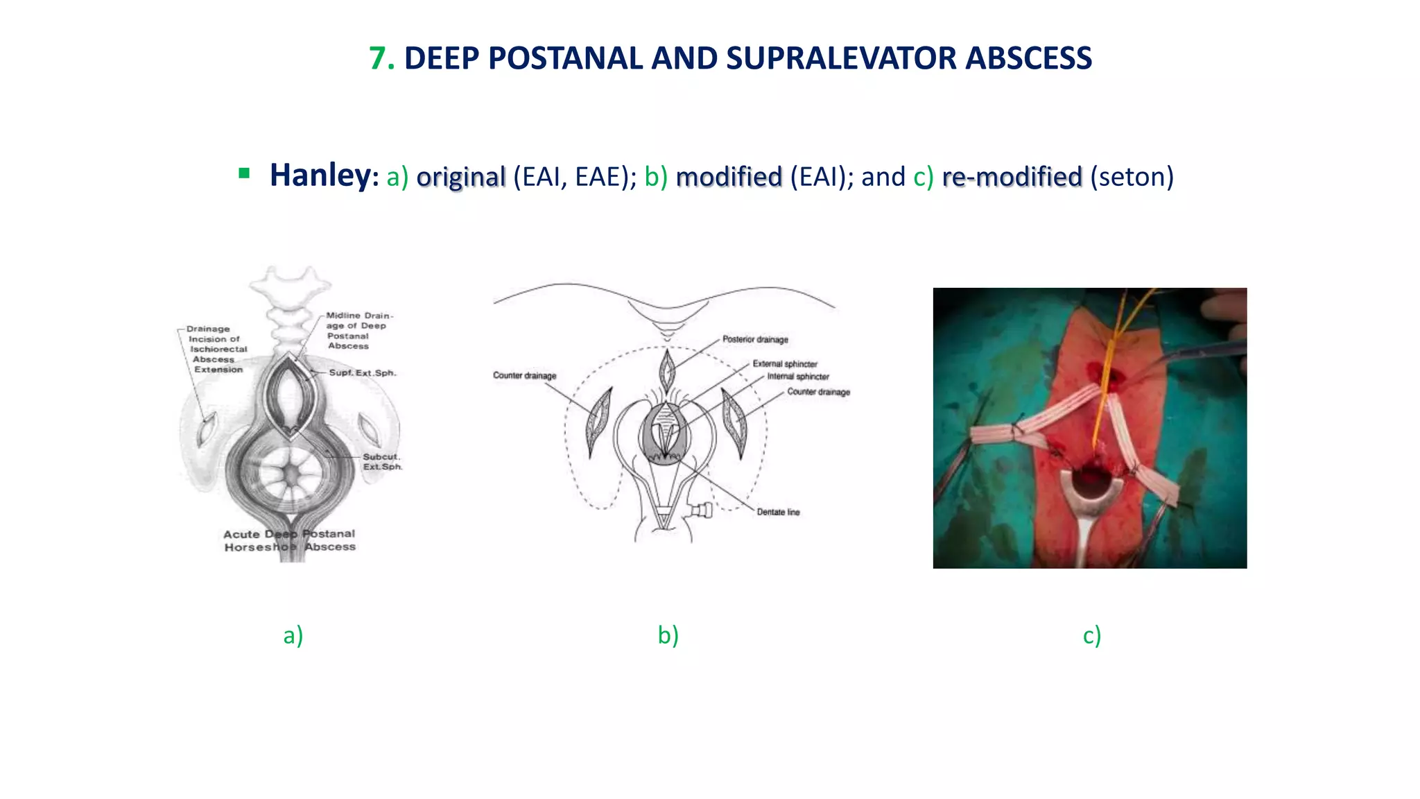 Anorectal abscess and fistula in ano | PPT
