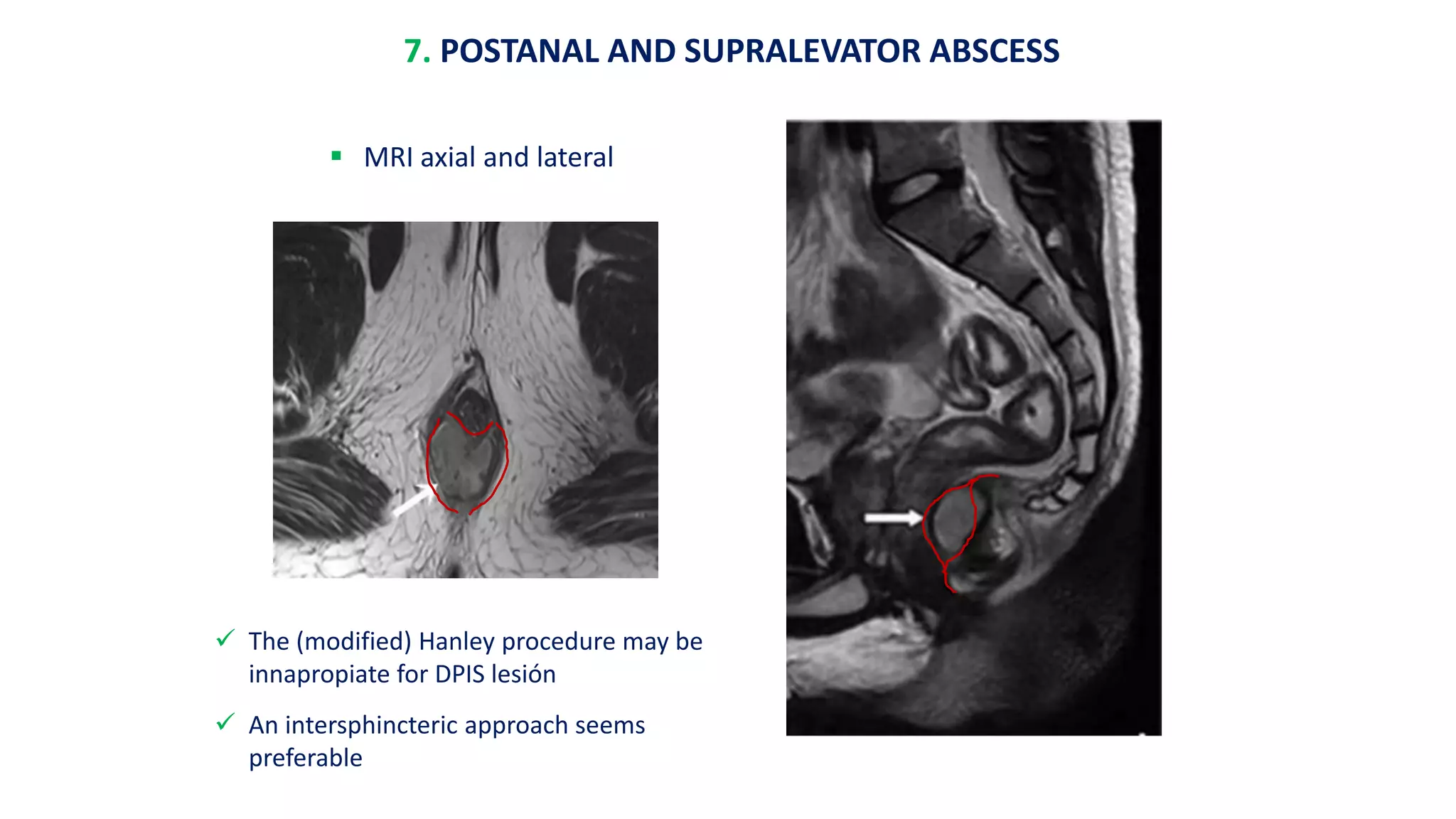 Anorectal abscess and fistula in ano | PPT