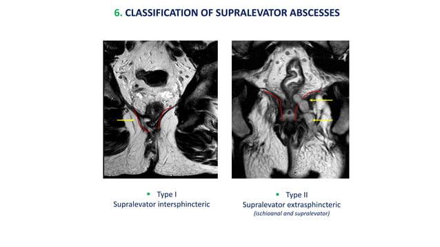 Anorectal abscess and fistula in ano | PPT | First Aid | Injuries