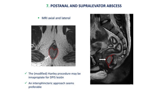 Anorectal abscess and fistula in ano | PPT | First Aid | Injuries