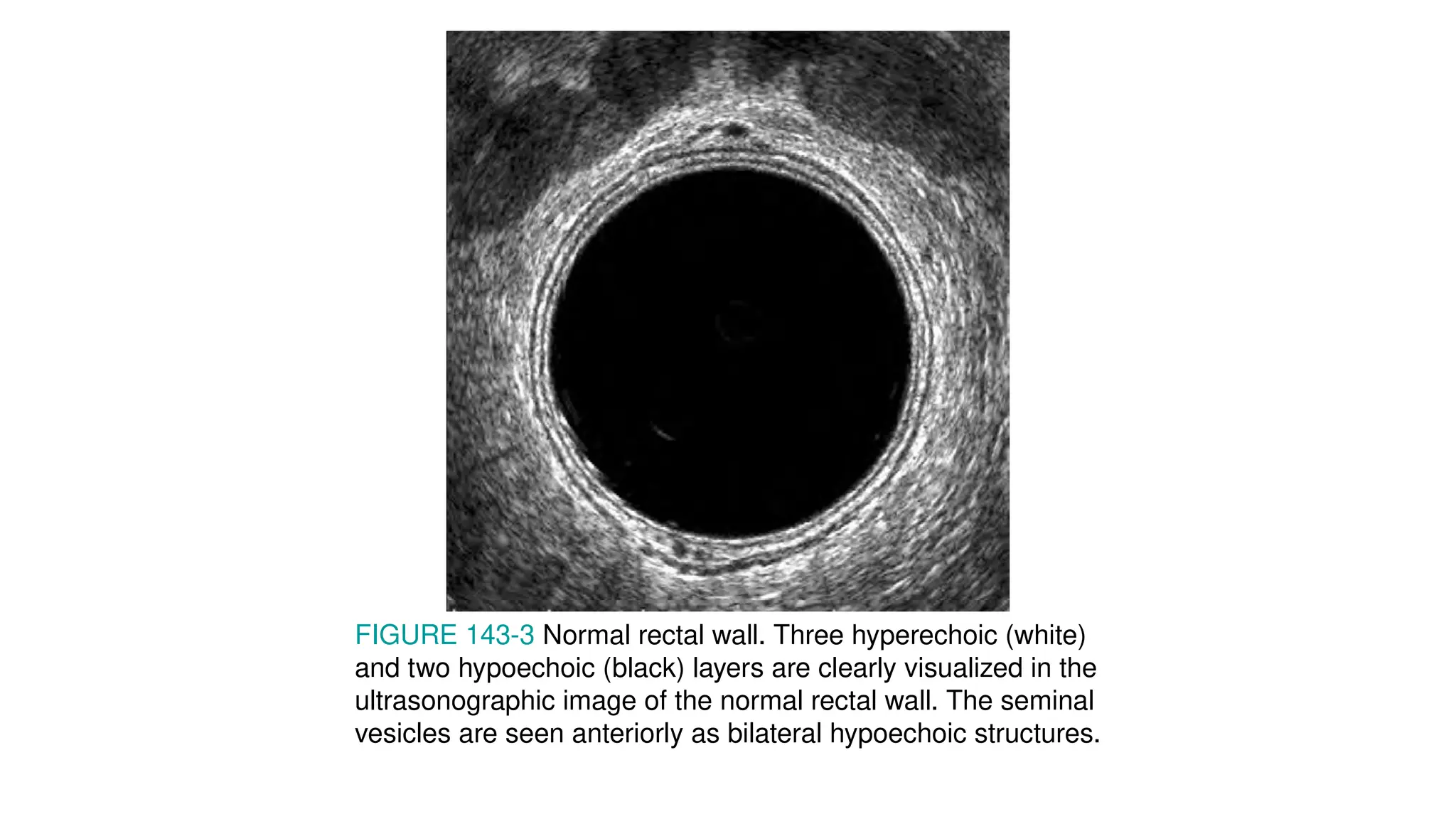 HDTV sucks just ANORECTAL ABSCESSES.pptx