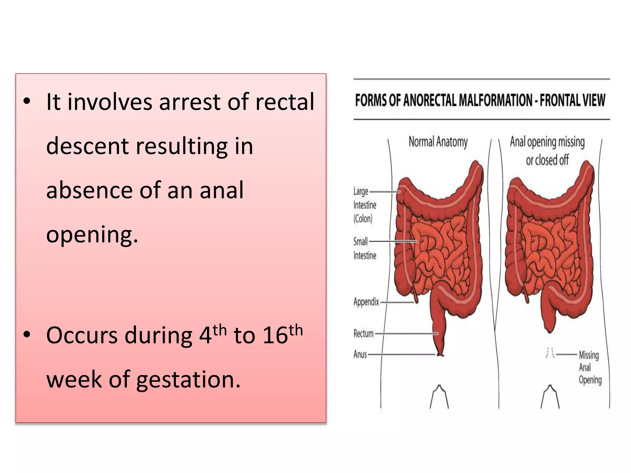 Anorectal Malformation | PPTX