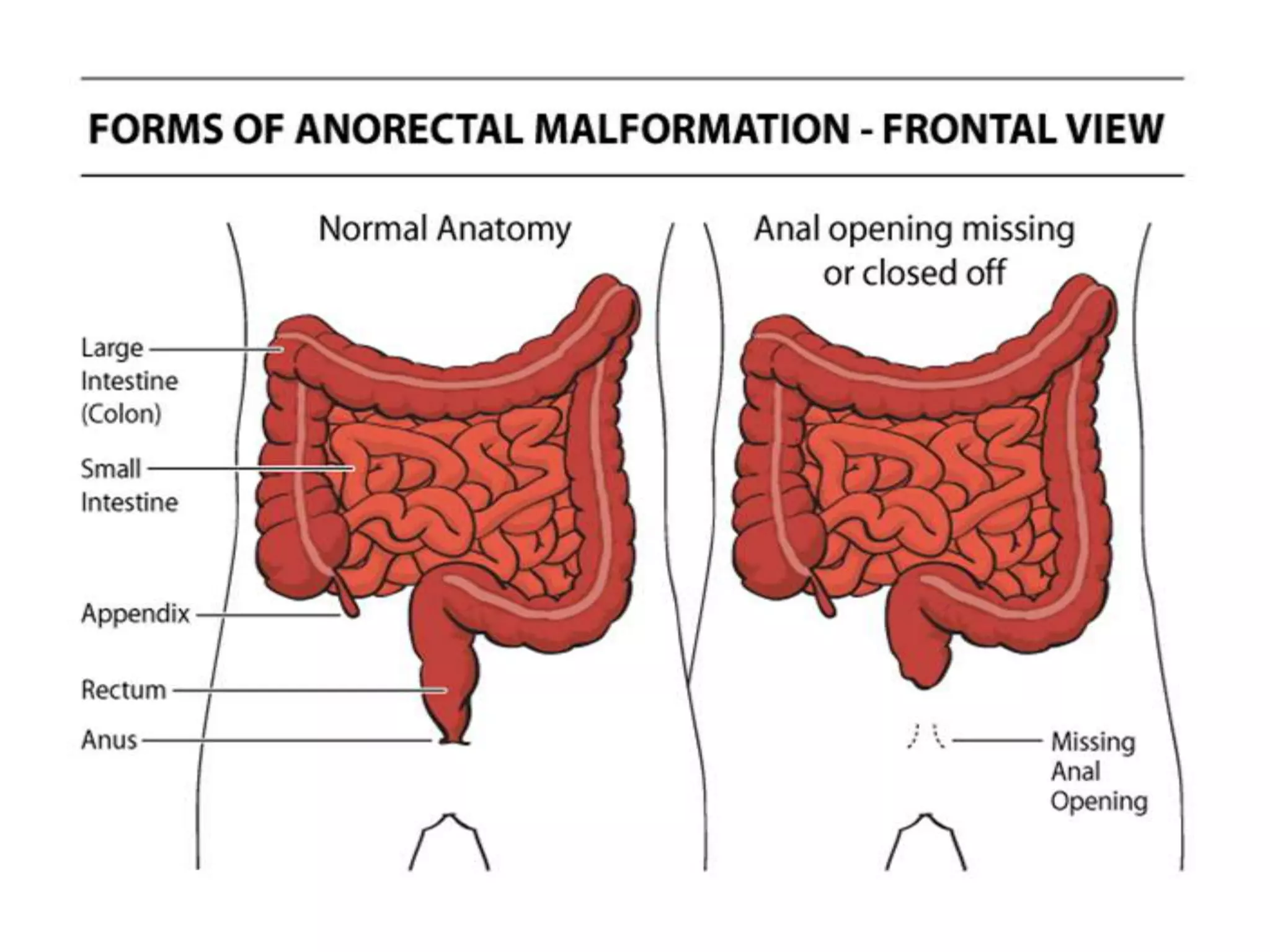 Anorectal Malformation | PPTX | Pregnancy | Reproductive Health