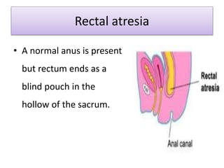 Anorectal Malformation | PPTX | Pregnancy | Reproductive Health