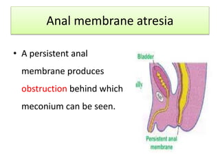 Anorectal Malformation | PPTX | Pregnancy | Reproductive Health