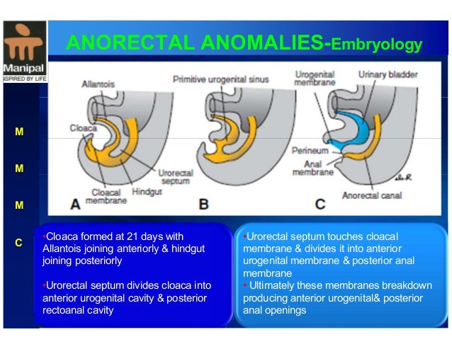 Anorectal anomaly(Imperforate Anus)