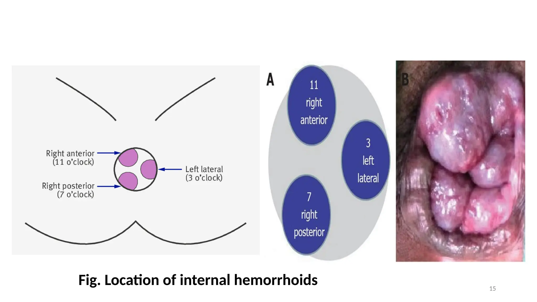 Benign anorectal disorders: Hemorrhoids, anal fissure, SRUS, Perianal abscess/fistula.pptx