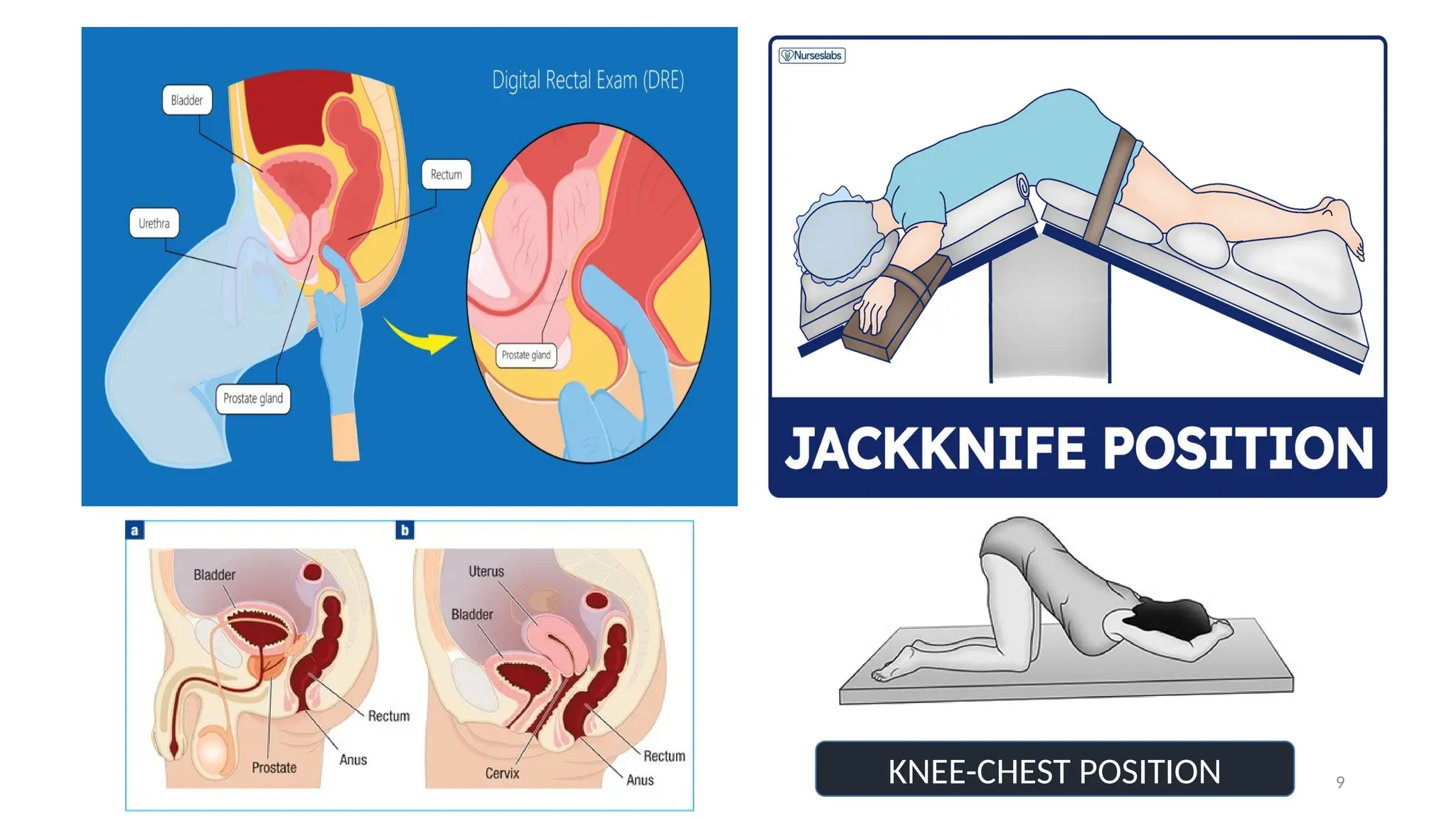 Benign anorectal disorders: Hemorrhoids, anal fissure, SRUS, Perianal ...