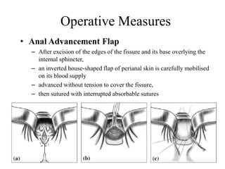 Anorectal disorders | PPT