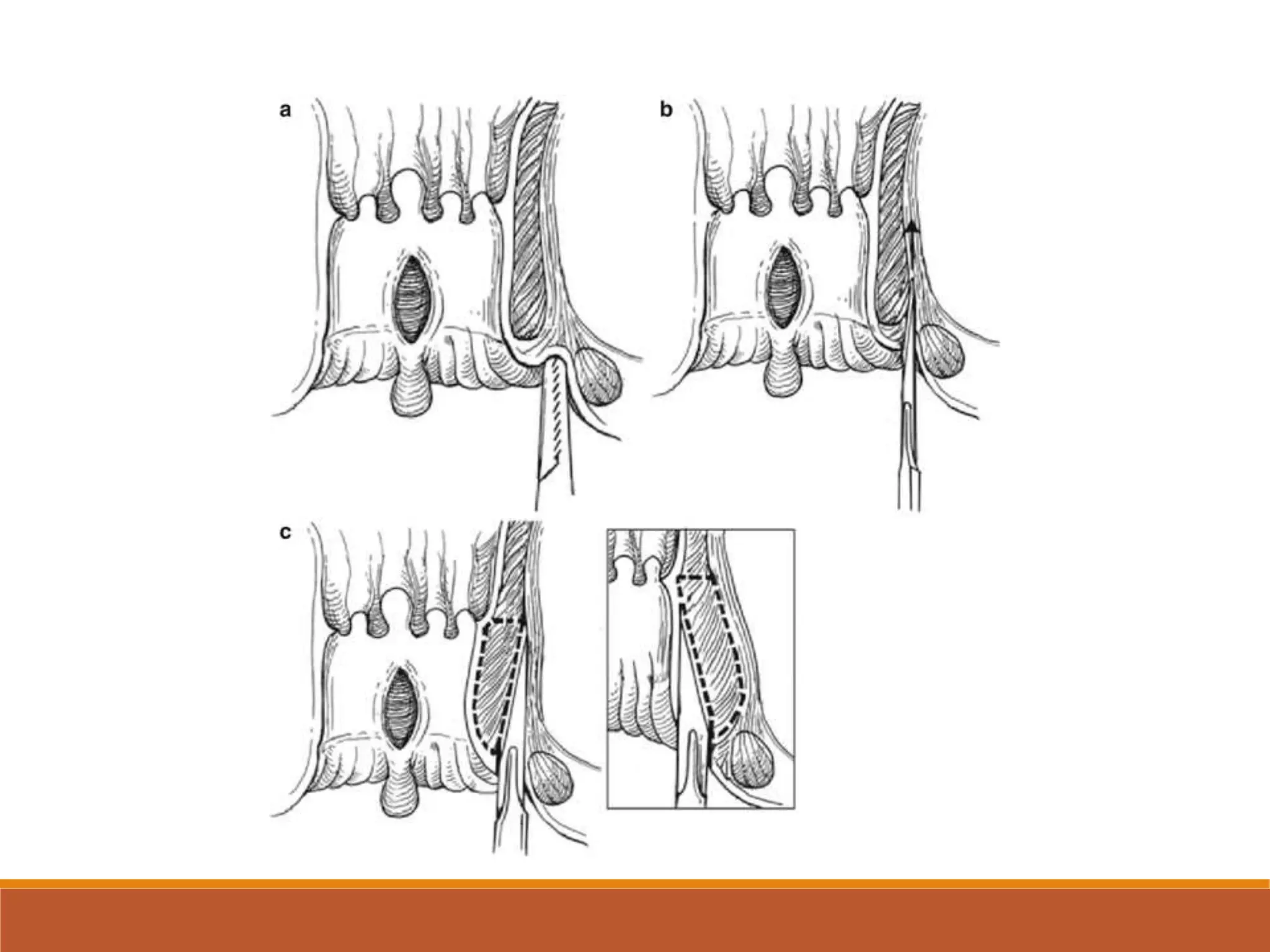 AnoRectal fissure,Abscess &fistula | PPTX