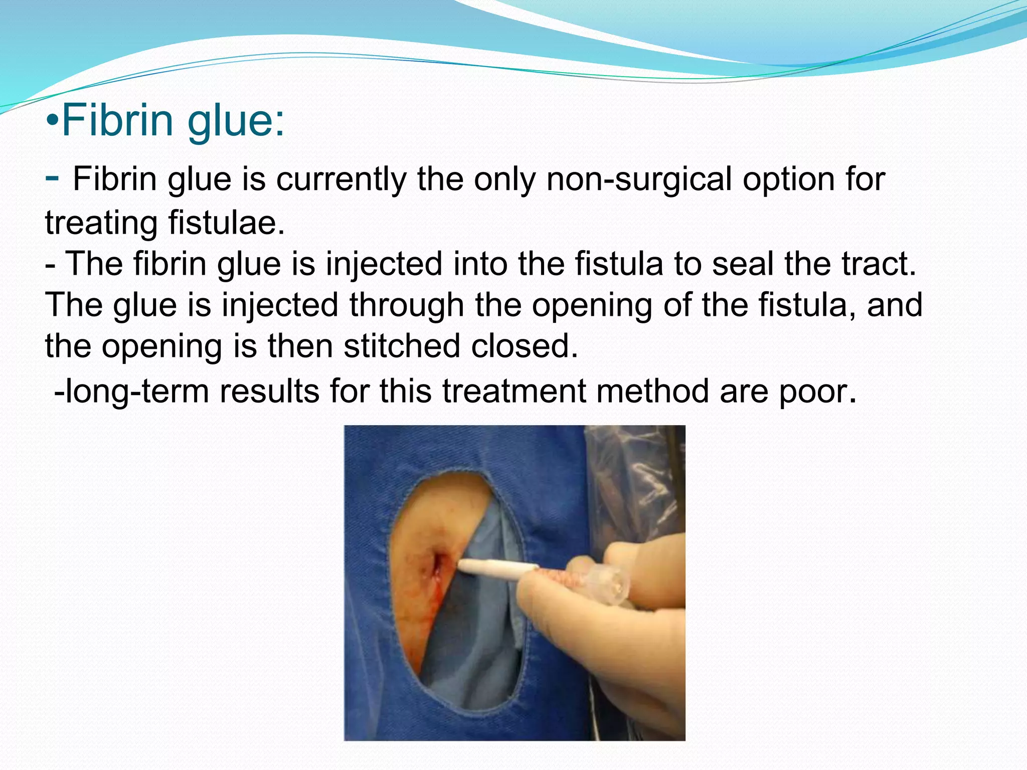 Anorectal fistula | PPTX