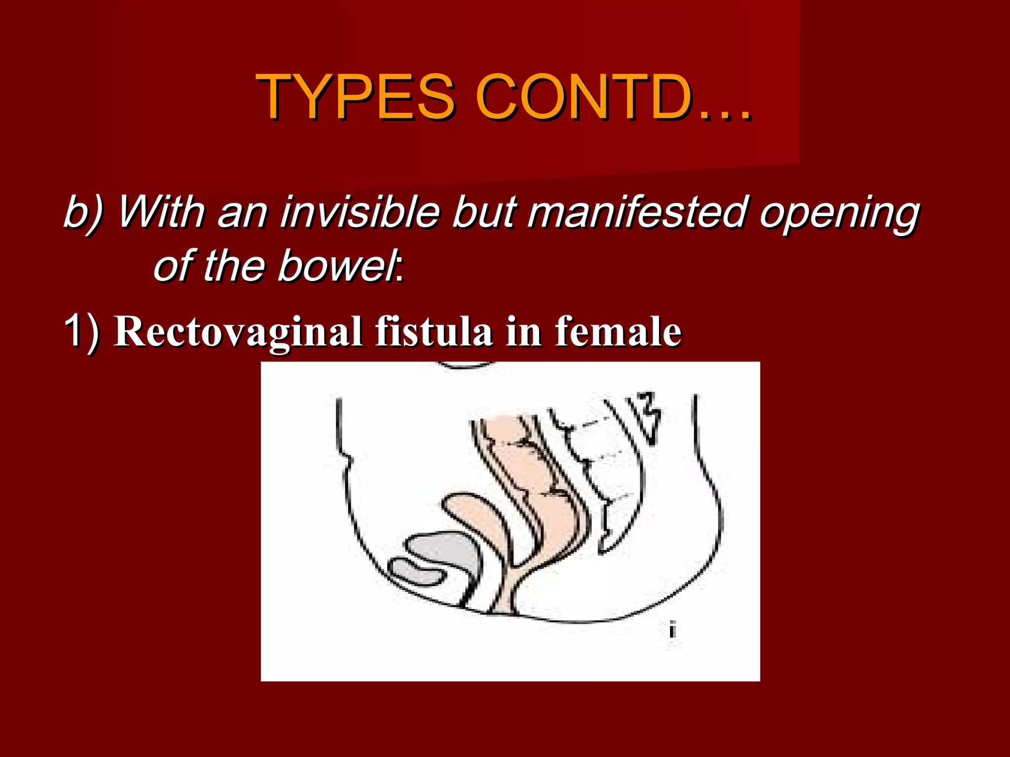 Anorectal malformation | PPT