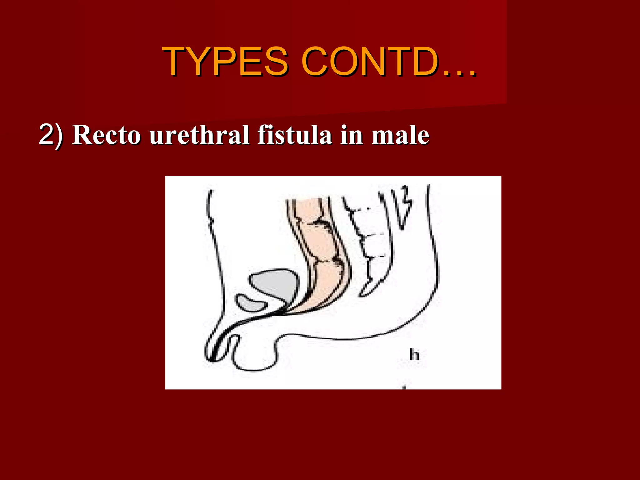 Anorectal malformation | PPT