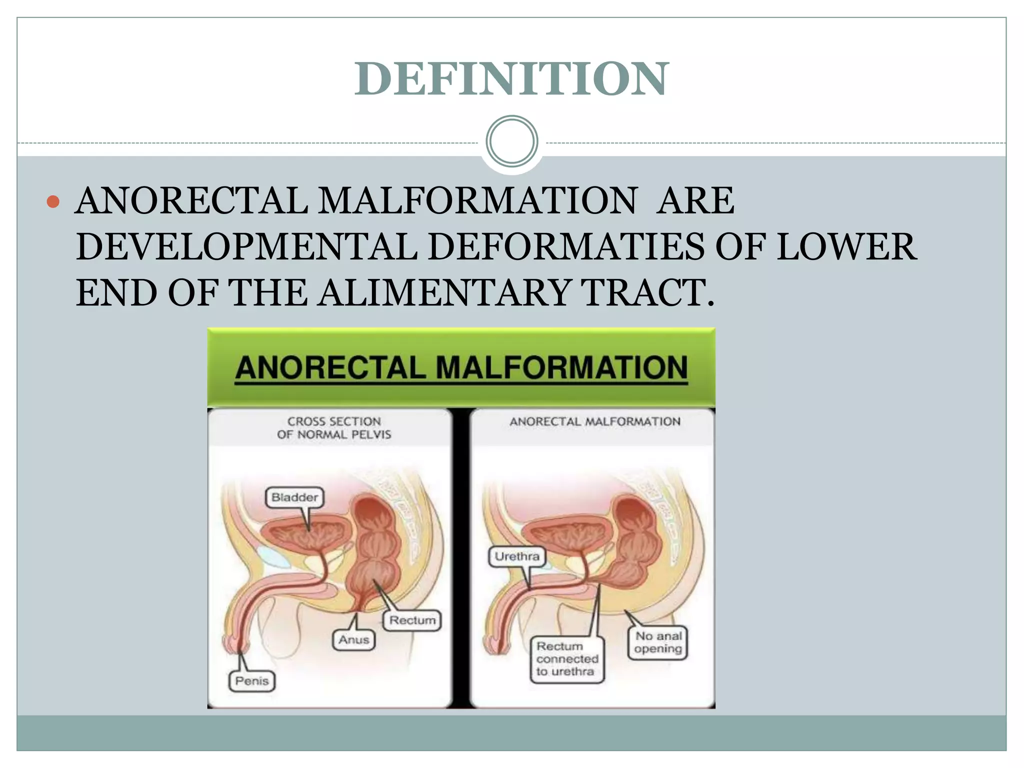 Anorectal malformation ........ | PPTX