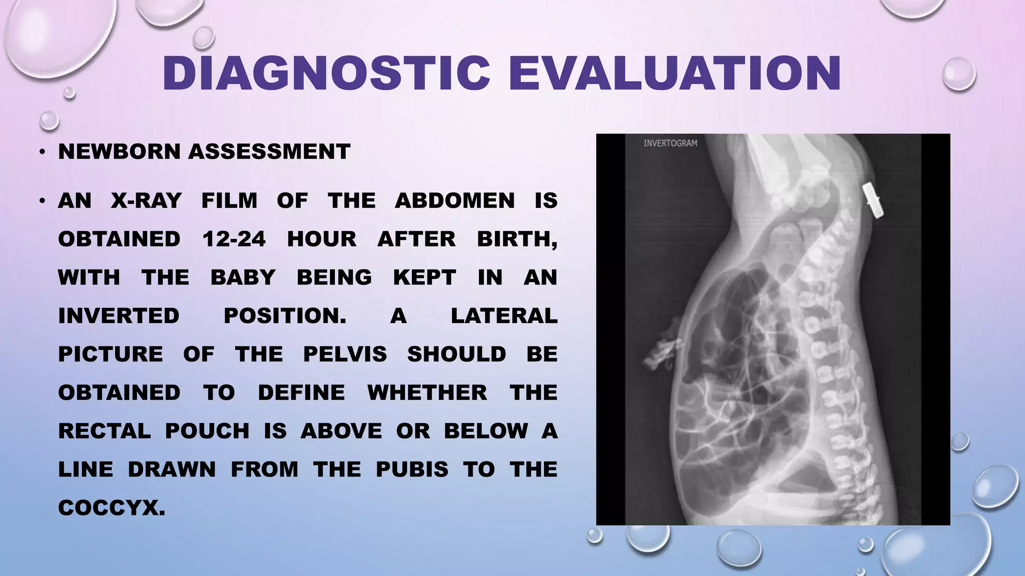 Anorectal Malformation For Bsc Nursing Pb Bsc Nursing Pptx