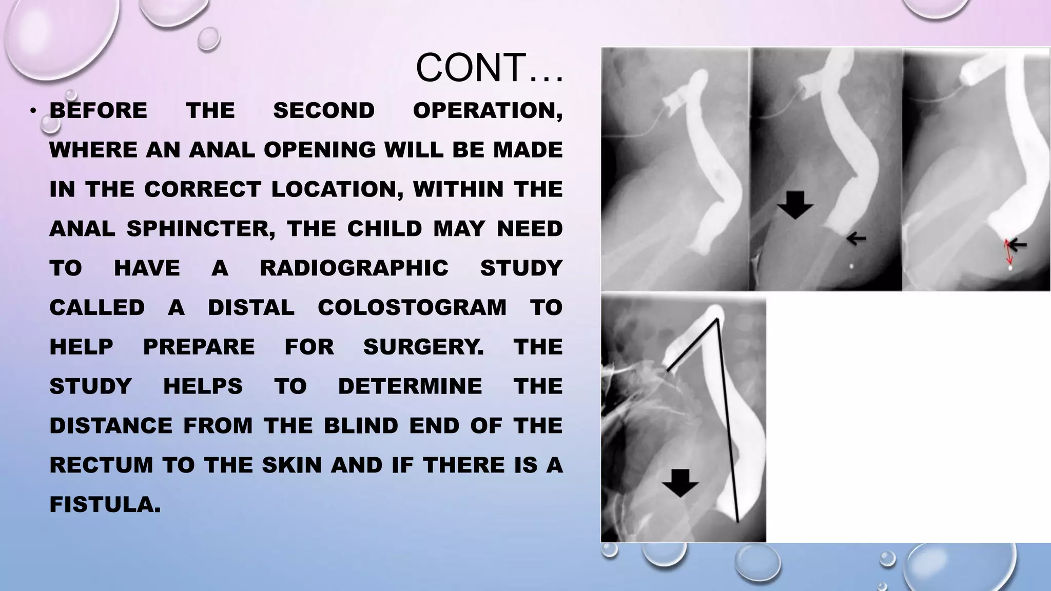 Anorectal Malformation for BSc Nursing/PB BSc Nursing | PPTX