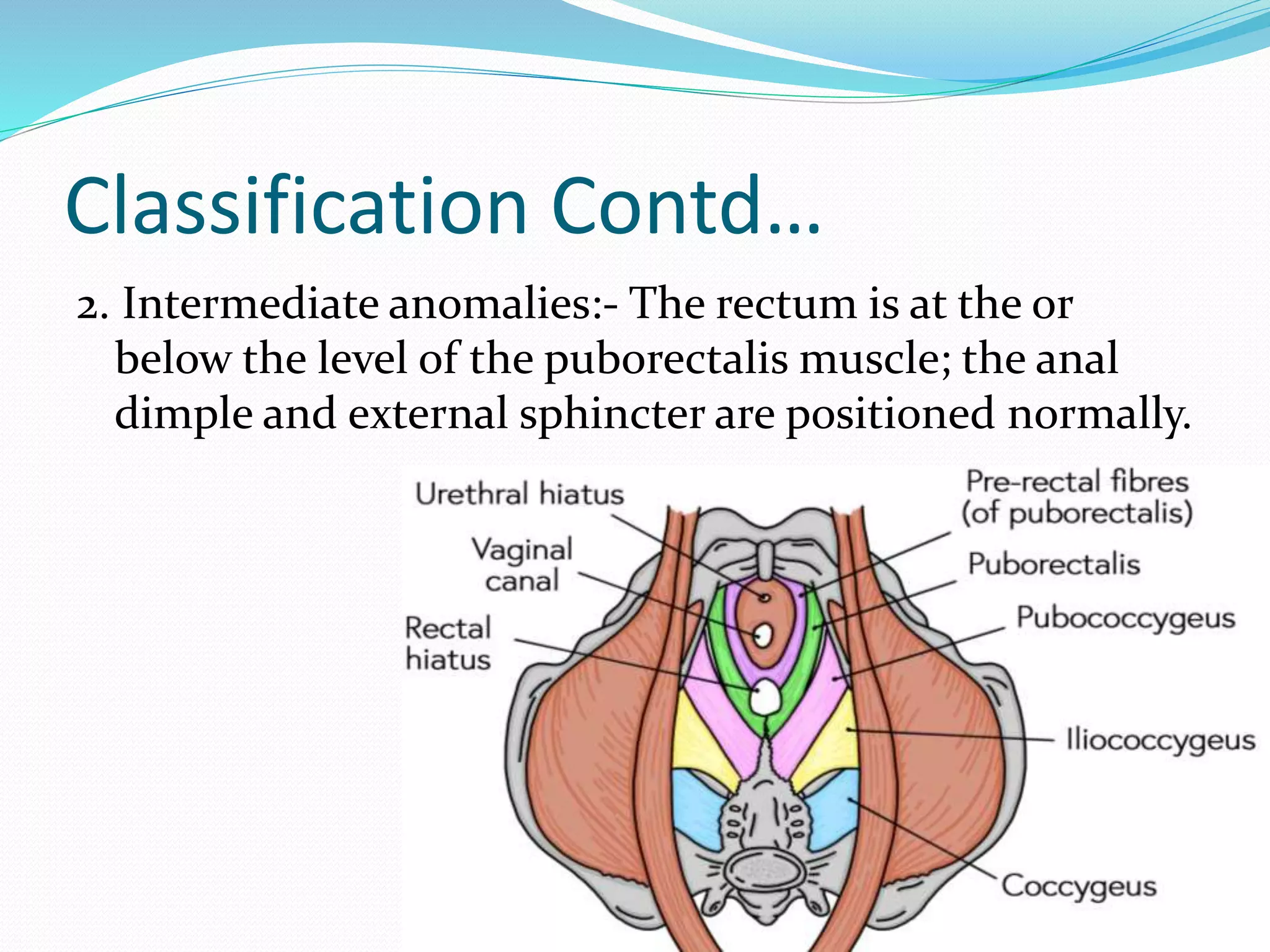 Anorectal malformation .pptx