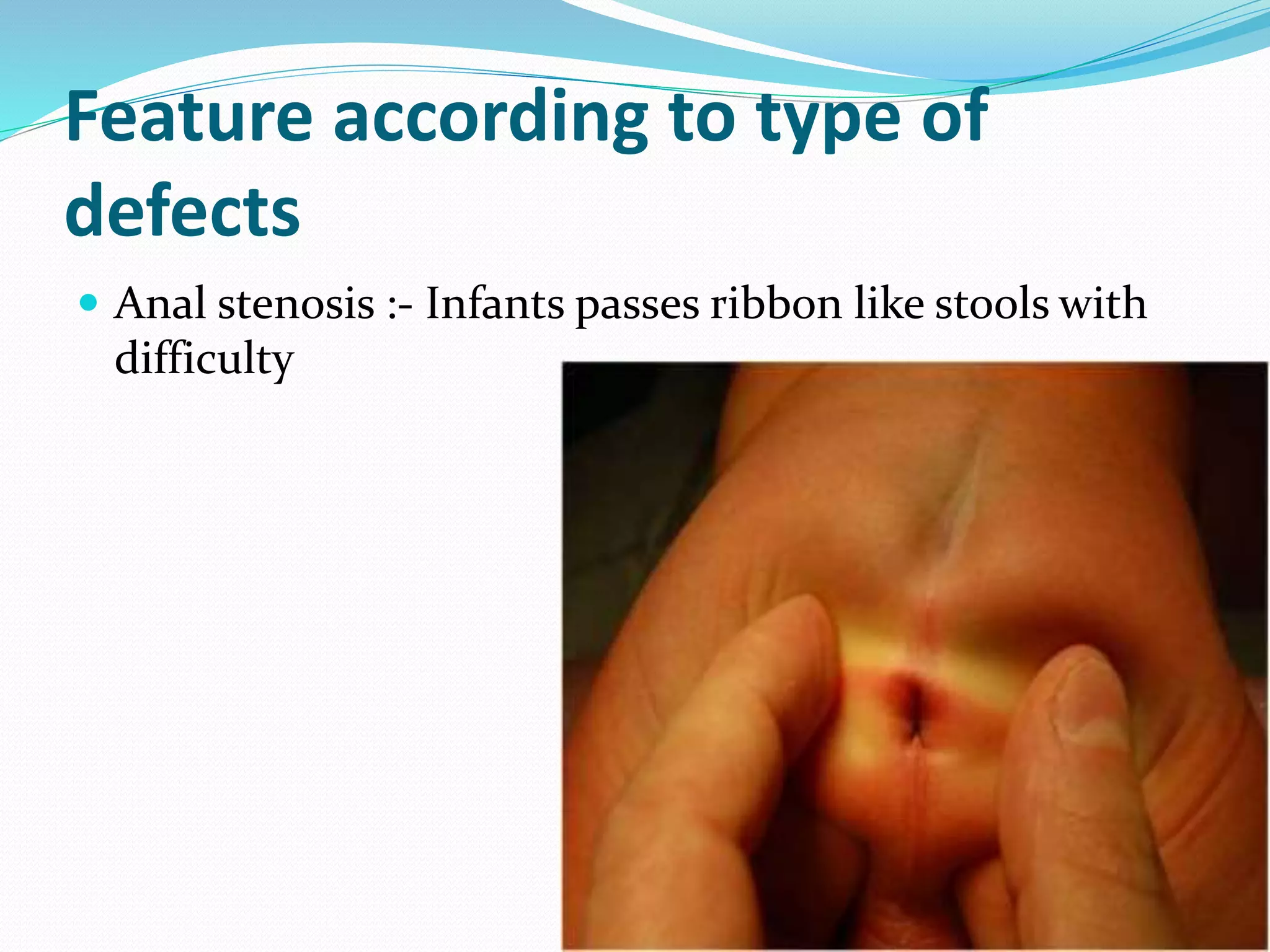 Anorectal malformation .pptx