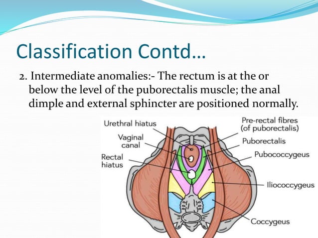 Anorectal malformation .pptx