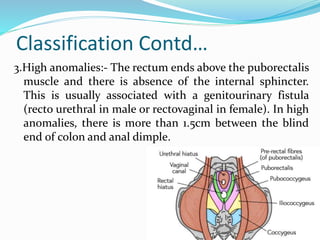 Anorectal malformation .pptx